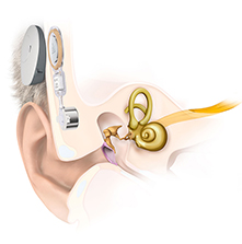 MED-EL | Cochlear Implants for Hearing Loss