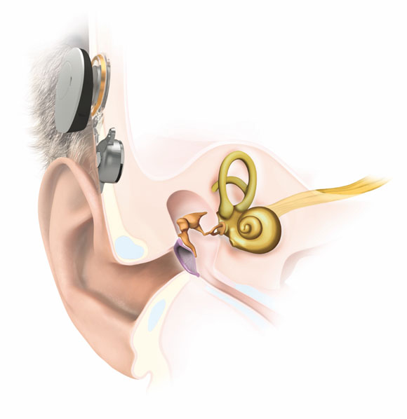 BONEBRIDGE Bone Conduction Implant